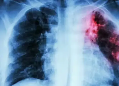 Perú impulsa el uso de una herramienta tecnológica para el tratamiento ...